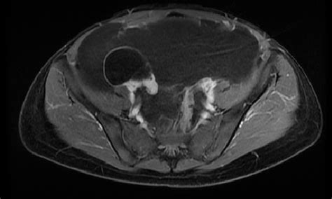 Resonancia magnética abdominal en corte T1 con supresión grasa post