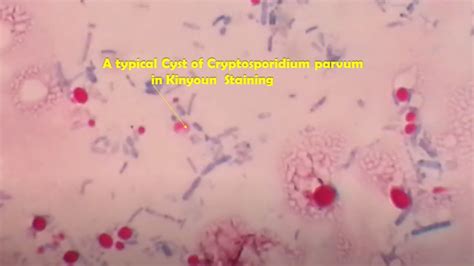 Cryptosporidium Parvum Cyst In A Patient Having Chronic Diarrhoea Youtube