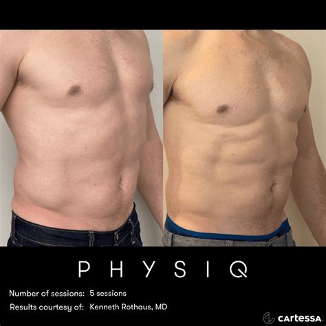 PHYSIQ Body Contouring Mt Pleasant SC Contour Aesthetics Wellness