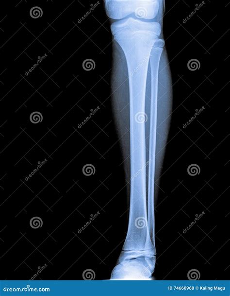 Fibula Bone Of Human On Isolated White Background Real Bone Stock
