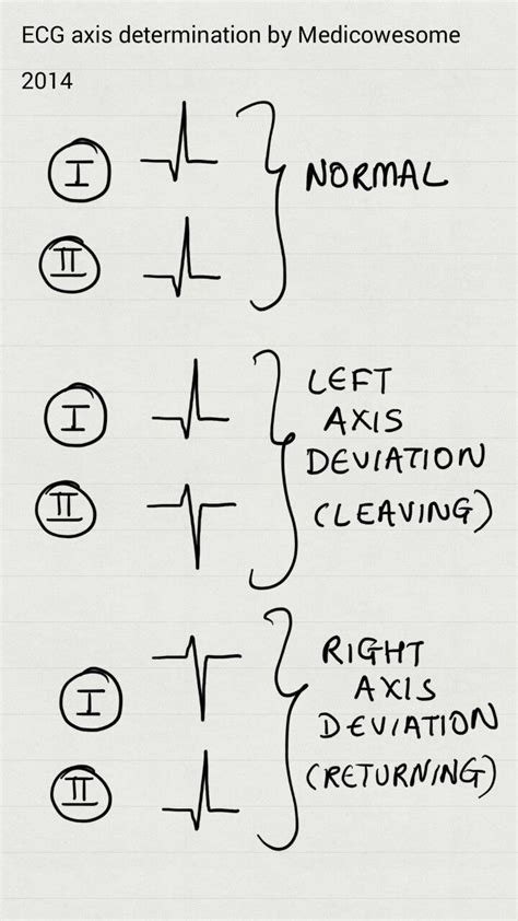 Medicowesome Evaluating Axis From ECG Mnemonic Hi Everyone We Are