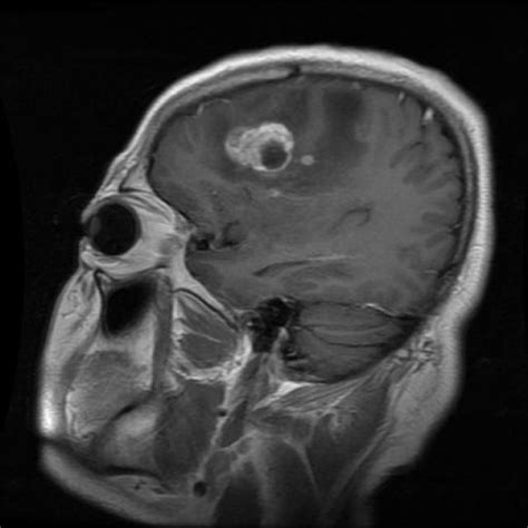 Labeled Mri Brain Tumor Dataset Object Detection Dataset V Version