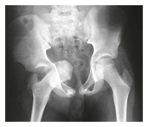 Displaced Right Acetabular Fracture Dislocation With Anterior Column