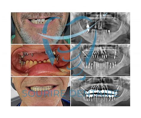 Implant Basal Bulgarie Sourire Dentaire