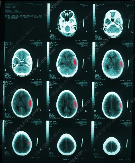 Cerebral CT Showing Subdural Haematoma Stock Image M136 0262