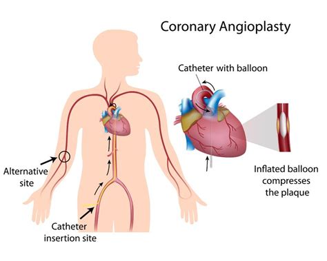 Coronary Intervention Angioplasty And Stent Placement