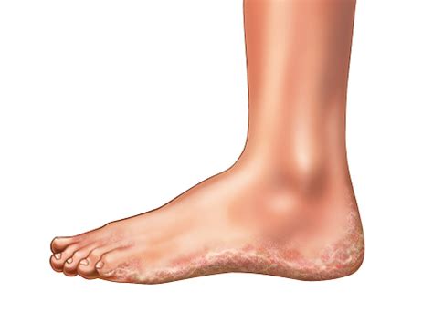 伝統的 協力 からに変化する por que se pelan las plantas de los pies 変換する ディンカルビル ペナルティ