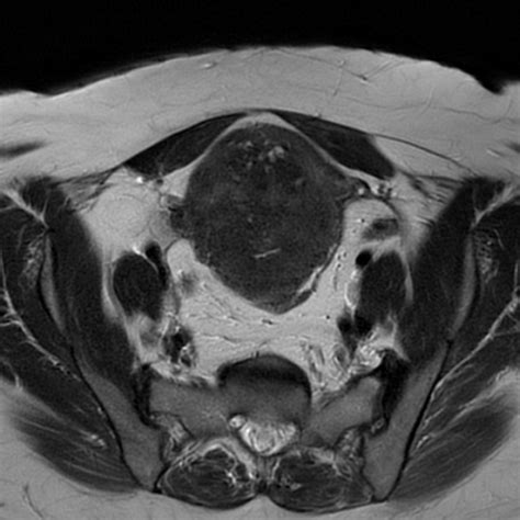Uterine Adenomyosis Image Radiopaedia Org
