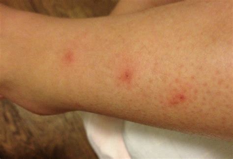 Carpet Beetle Bites Images Homeminimalisite