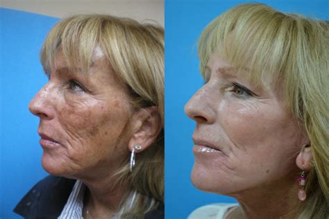 Laser Skin Resurfacing Before After Gallery