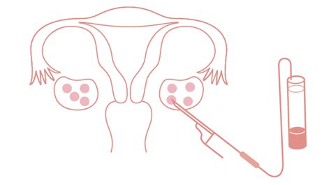 IVF Egg Retrieval Process Procedure Recovery Risks And 40 OFF