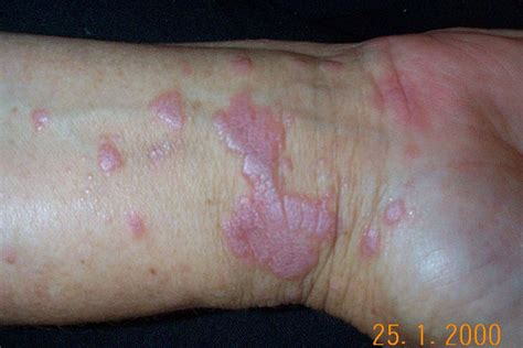 Eczema Vs Psoriasis How To Tell Them Apart
