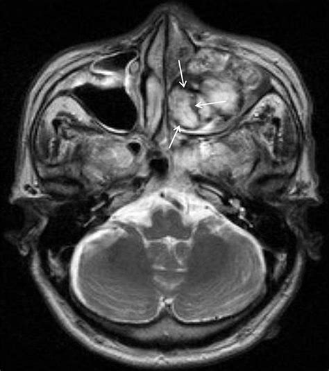 T2 Weighted Magnetic Resonance Imaging Of The Mass Axial T2weighted MR