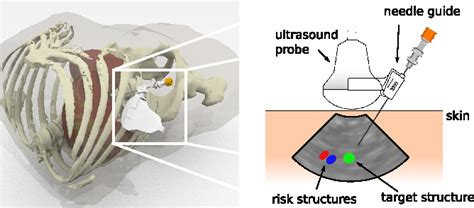 figure 1 from a virtual reality system for ptcd simulation using direct visuo haptic rendering