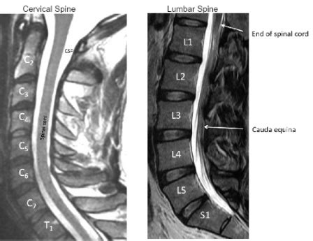 Differences Between A Normal Vs Abnormal Cervical Spine Mri Off