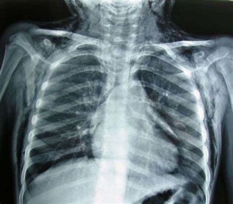 PA Chest Radiograph On The First Admission Demonstrates Subcutaneous