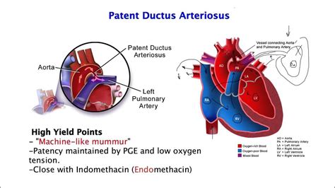 Patent Ductus Arteriosus Patent Ductus Arteriosus Ductus Arteriosus