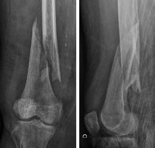 Tratamento De Fraturas Do F Mur Distal Dr Leonardo Rocha Thomaz
