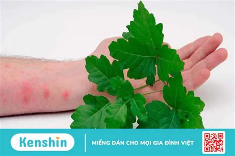 Dị ứng cây sơn độc Nguyên nhân và cách phòng tránh dị ứng Miếng dán