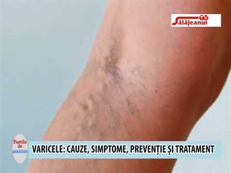 PASTILA DE SANATATE VARICELE CAUZE SIMPTOME PREVENTIE SI TRATAMENT