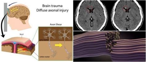 Diffuse Axonal Injury Causes Symptoms Diagnosis And Treatment