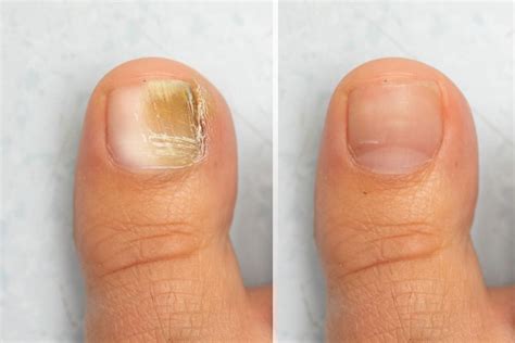 Laser Away That Yellow Toenail Fungus Before Summer Board Certified