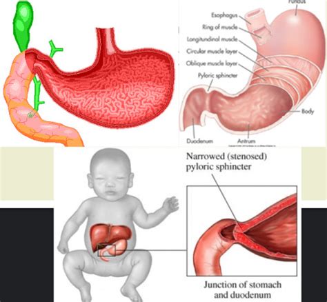 Gi Pathology Flashcards Quizlet