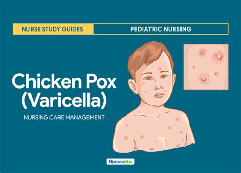 Chicken Pox Virus
