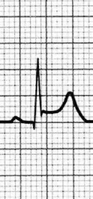 Ekg Ii Wave Forms Segments And Intervals Flashcards Quizlet