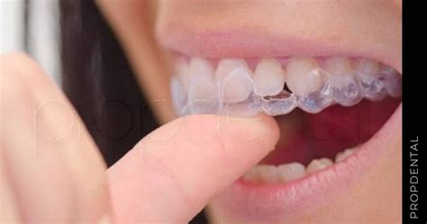 Ventajas E Inconvenientes De Los Diferentes Tipos Aparatos Dentales