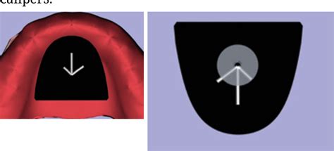 Figure 8 From Using Intraoral Gothic Arch Tracing To Balance Full