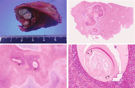 Macroscopic And Microscopic Findings Of The Resected Specimen The