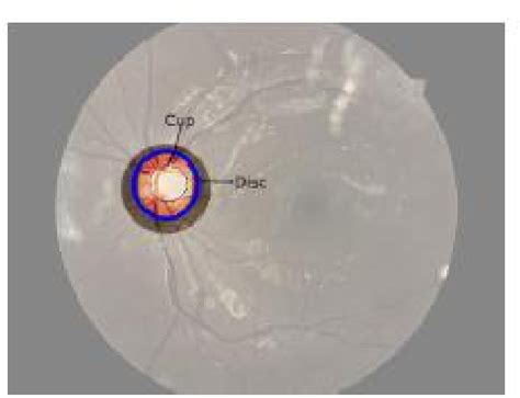 Figure From Retinal Glaucoma Detection From Digital Fundus Images