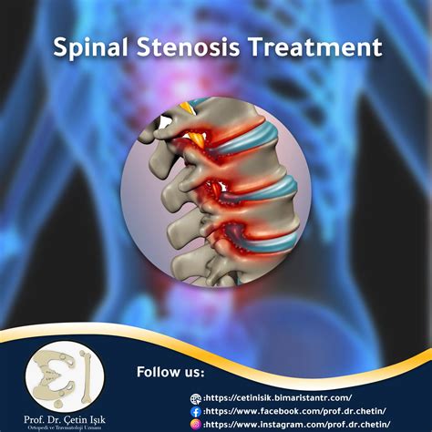 Spinal Stenosis Treatment Dr What S Wrong With You