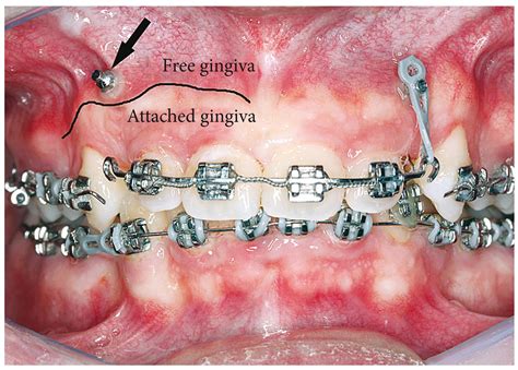 Mini Implants The Orthodontics Of The Future Ubicaciondepersonas Cdmx