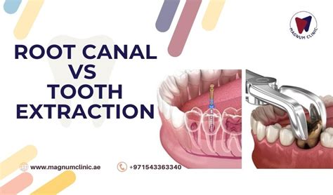 Root Canal Vs Tooth Extraction Top Factors To Consider