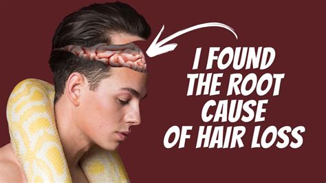 Hidden Connection Hair Loss And Tension Myositis Syndrome YouTube