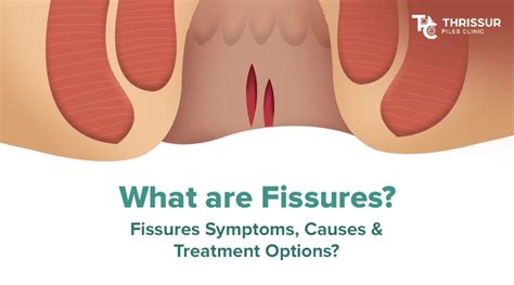 What Are Fissures Fissures Symptoms Causes Treatment Options