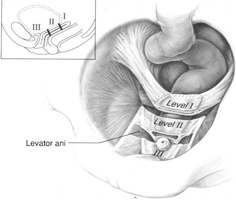 What Happens To Pelvic Floor After Hysterectomy Viewfloor Co