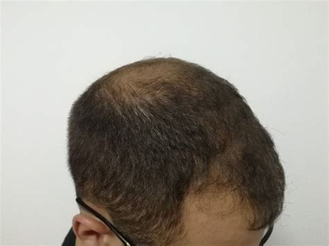 Tratamiento capilar con mesoterapia Láser capilar LedHair