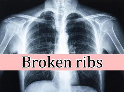 Rib Bone Fracture Healing Time At Johnmmccrary Blog