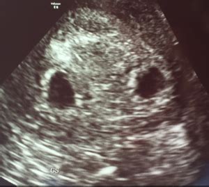 Ultrasound Pictures Of Twins At Weeks The Meta Pictures