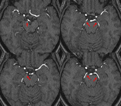 Posterior Cerebral Artery Neuroangio Org