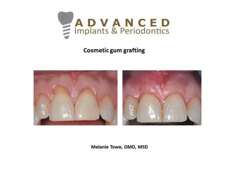 Cosmetic Gum Grafting Advanced Implants Periodontics