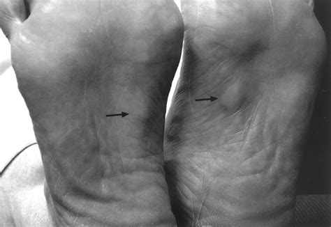 Sonography Of Plantar Fibromatosis AJR