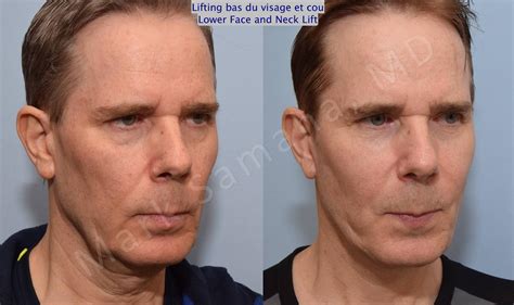 Lifting du visage Cou Facelift Necklift Avant Après Photos