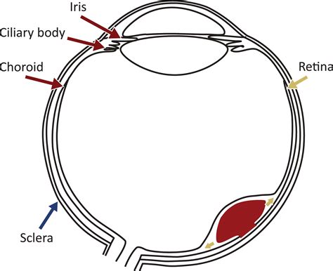 Orbital Neoplasms In Adults Clinical Radiologic And Pathologic