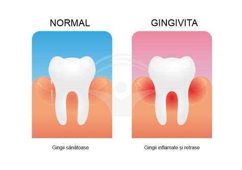 Gingivita Cauze Simptome Diagnostic Si Tratament The Best Porn Website