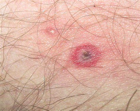 Normal Tick Bite