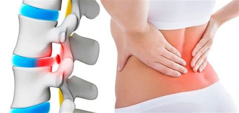 Was Ist Ein Bandscheibenvorfall Ursachen Symptome Und Therapie